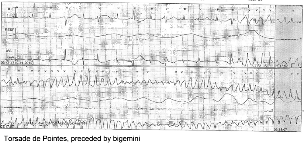 LQTS - Textbook of Cardiology