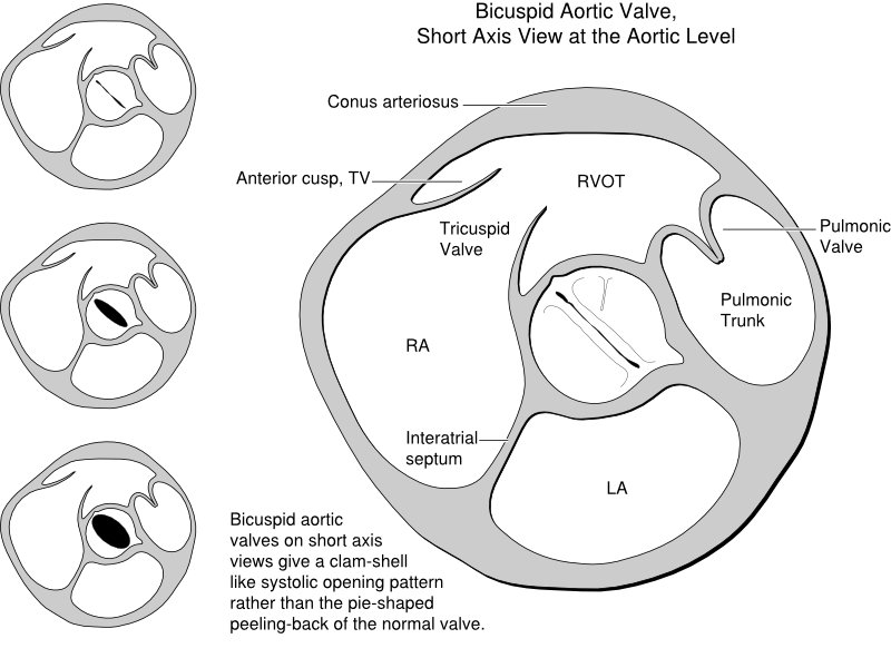 Valvular Heart Disease - Textbook of Cardiology