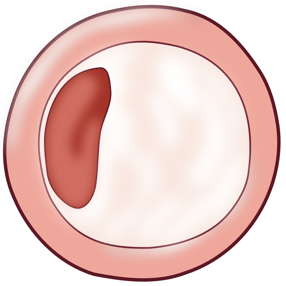 File:Plaque rupture D.svg - Textbook of Cardiology
