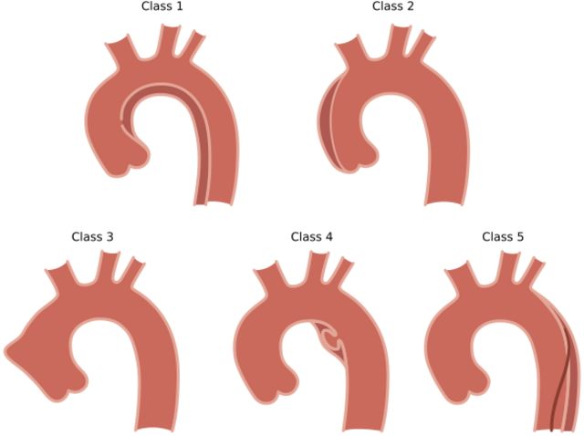 Aortic Dissection - Textbook of Cardiology