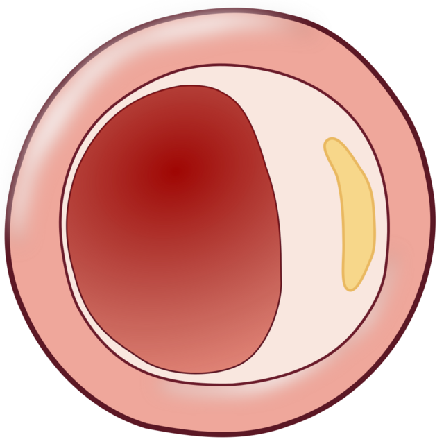 File:Plaque rupture A.svg - Textbook of Cardiology