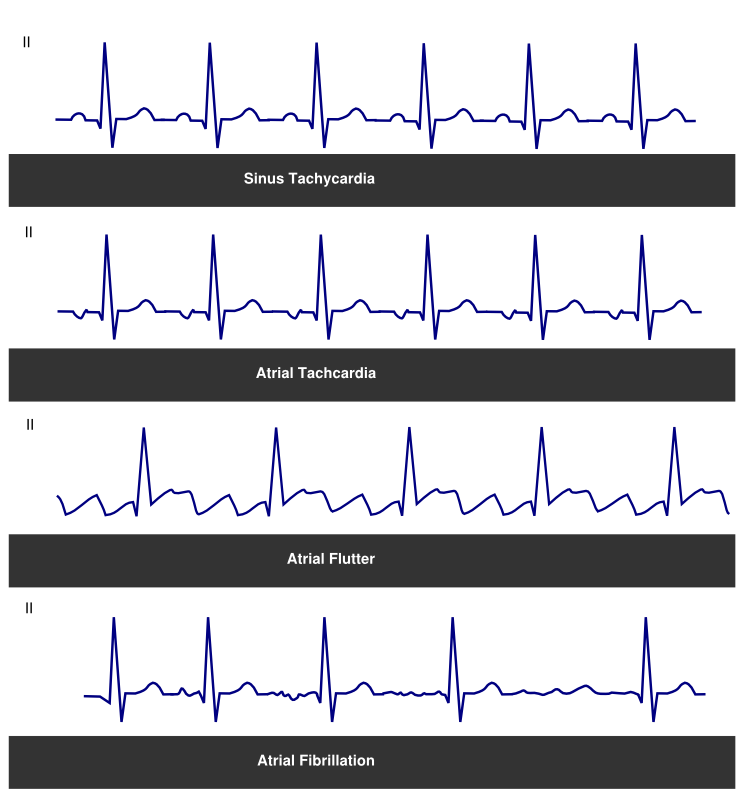 Tachycardia - Textbook of Cardiology