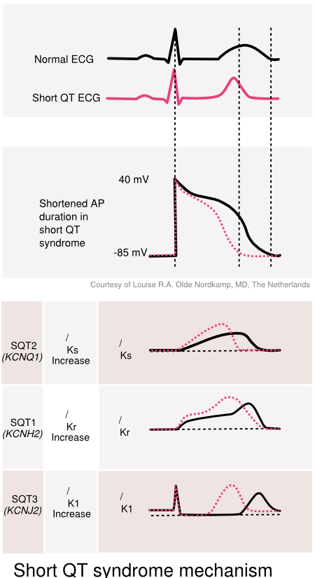 SQTS - Textbook of Cardiology