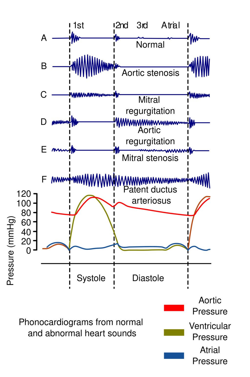 File:Phonocardiograms from normal and abnormal heart sounds.svg ...