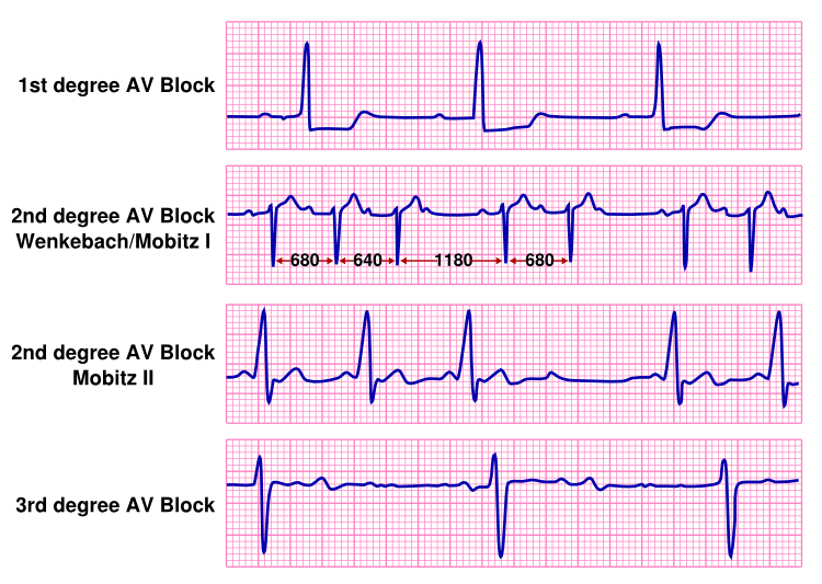 Bradycardia - Textbook of Cardiology
