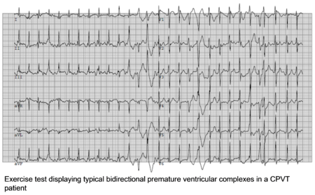 CPVT - Textbook of Cardiology